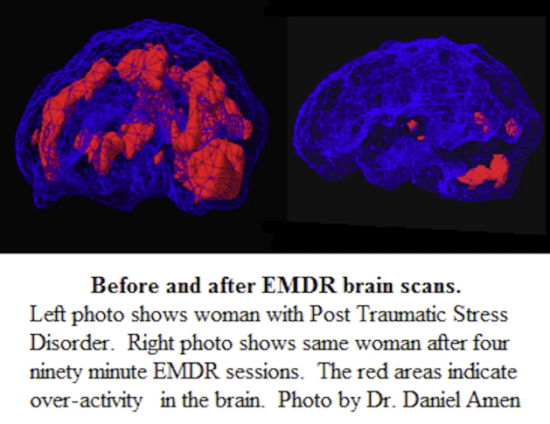 What is EMDR Therapy | Inspired Happiness Therapy LLC